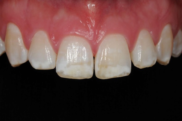 მინანქრის თეთრი ლაქები – ყველაფერი სტომატოლოგიაზე